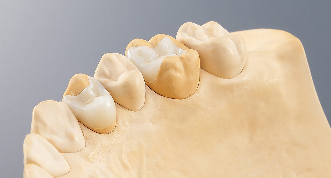 DWX-52DCi Dental Milling Machine Applications | Roland DG